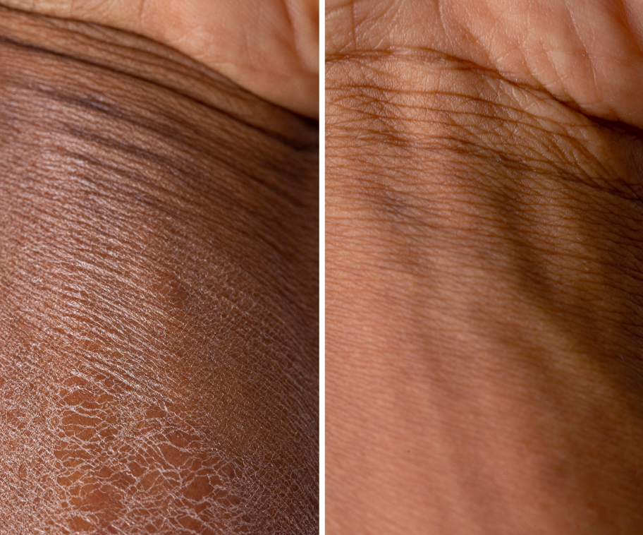 How to Treat Ashy Skin – Doctor Rogers Skin Care