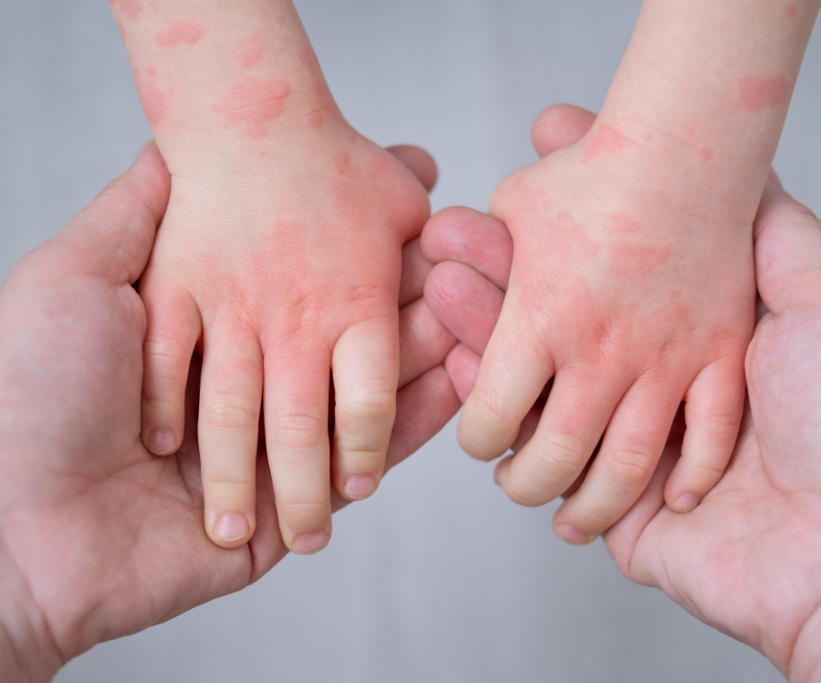 Eczema In Children | Doctor Rogers Skin Care