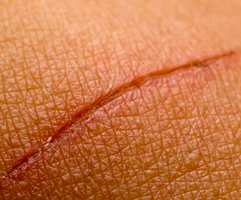 How to Heal a Cut or Wound – Doctor Rogers