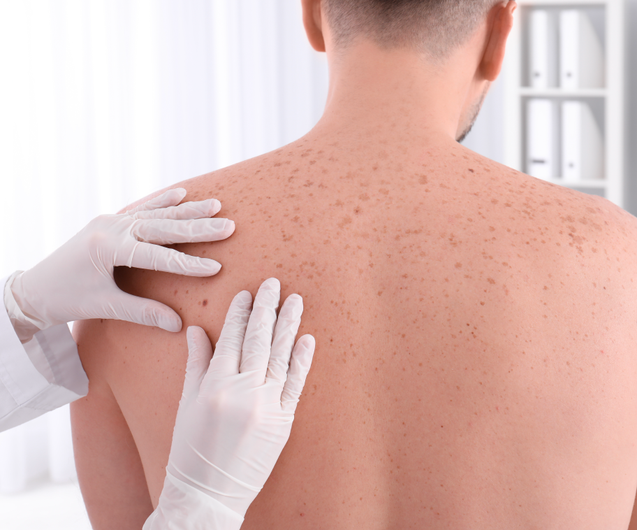 Skin Cancer 101: Types, Symptoms, Treatment and How to Prevent | Dr ...